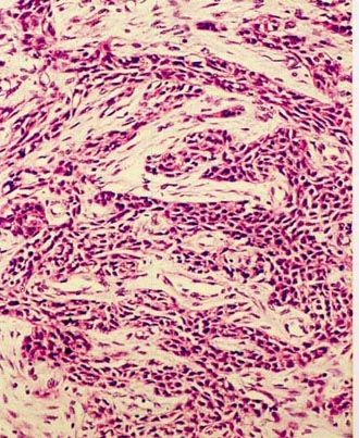 Back uncommon malignant primary bone tumormost common in tibial shaft ...