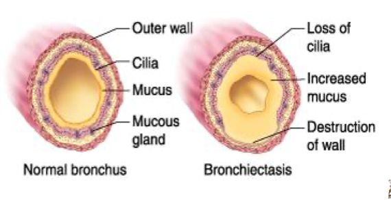 Front What are the congenital conditions thatcause bronchiectasis?