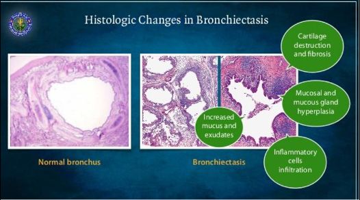 Front What are the congenital conditions thatcause bronchiectasis?