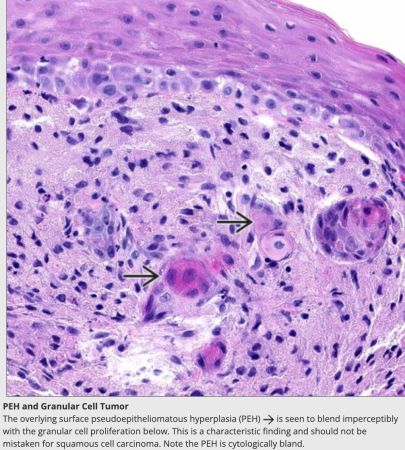 Extra DDx: Granular cell tumor is believed to be derived from Schwann ...