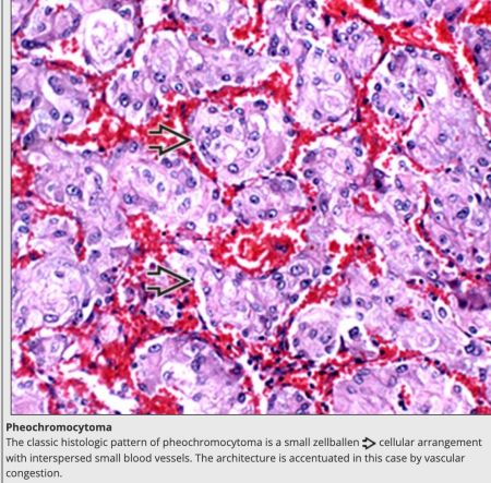 Text Histological appearance of pheochromocytomaHow do you define ...