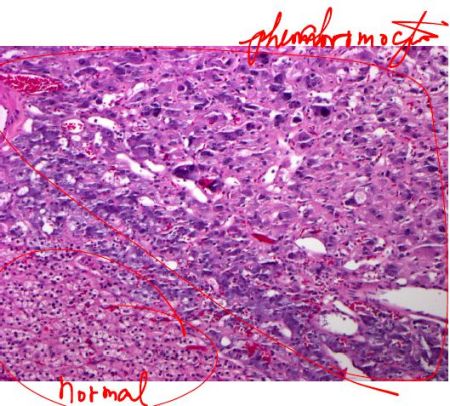 Text Histological appearance of pheochromocytomaHow do you define ...
