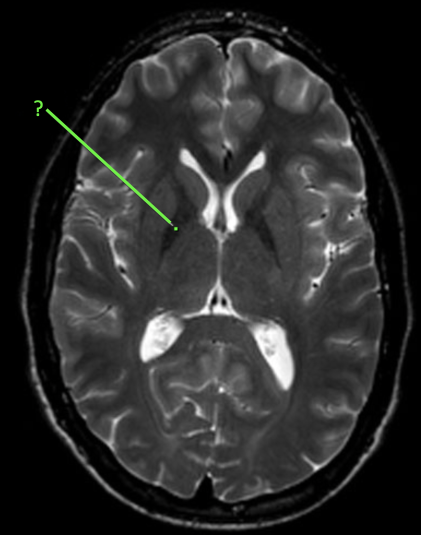 Text {{c1::Posterior limb of internal capsule::Structure?}}