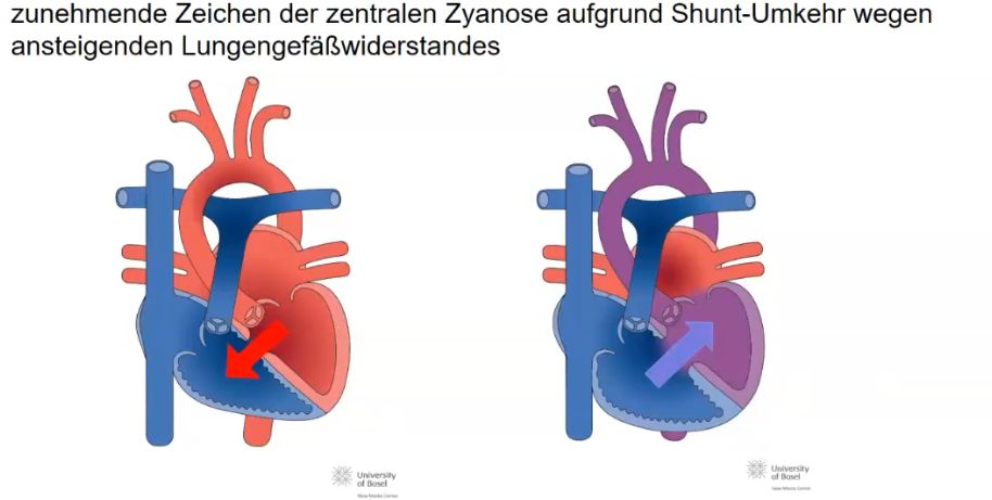 Back Das Auftreten einer Zyanose als Folge einerShunt-Umkehr bei ...